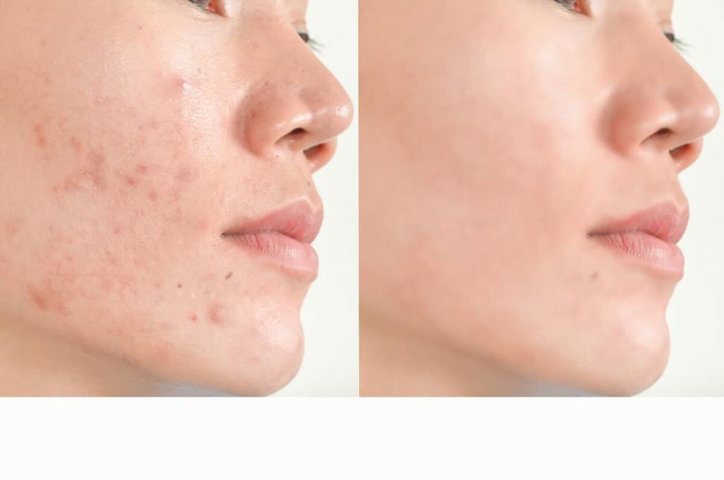 Acne Treatment St. Louis - How to get rid of Acne?