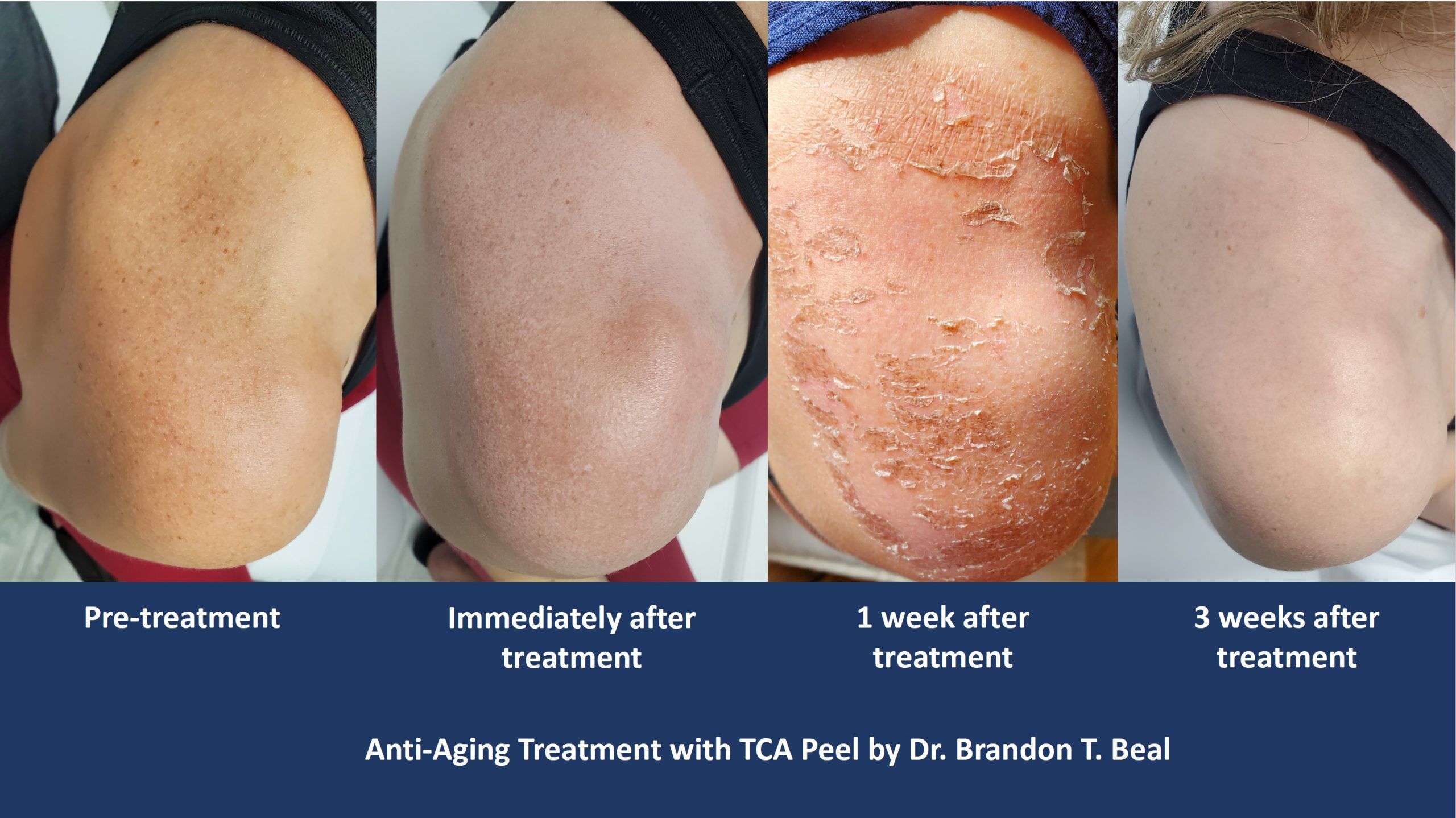 Chemical Peel St Louis Chemical Peel For Brown Spots And Facial Fine Chemical Peel St Louis Chemical Peel For Brown Spots And Facial Fine