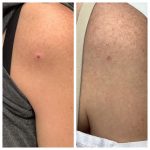 Cherry Angioma Before and After St. Louis | Cherry Angioma Treatment ...