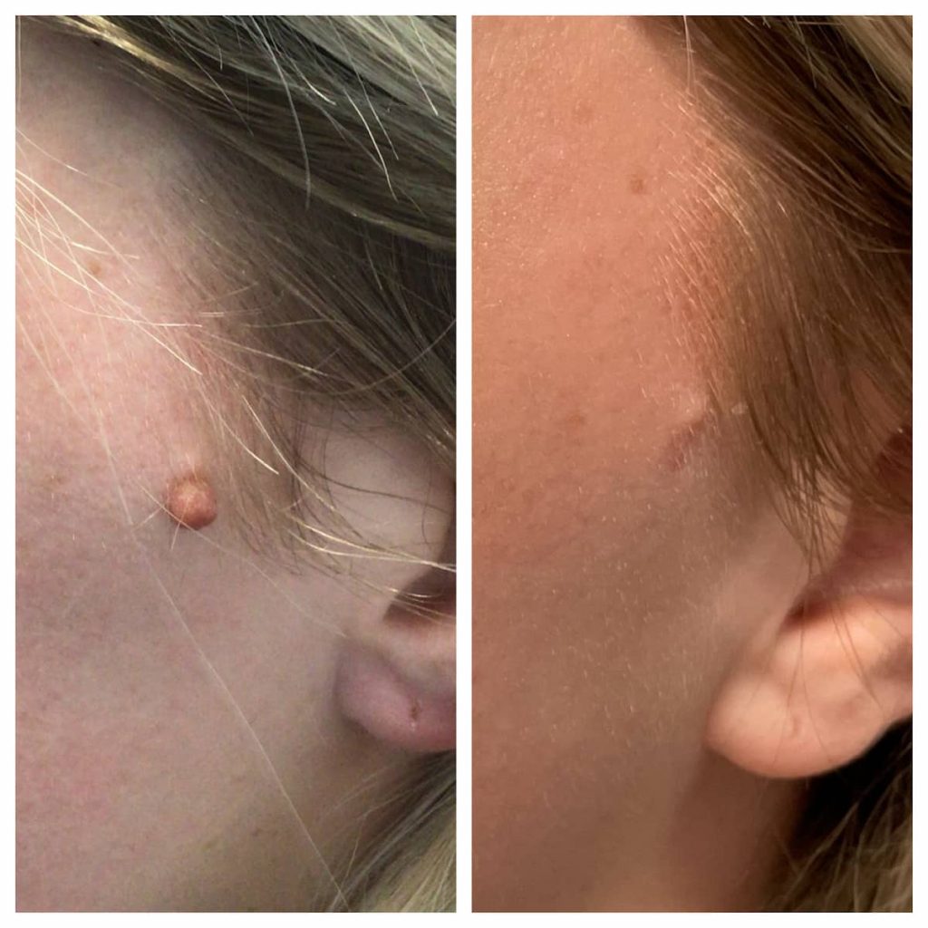 Mole Removal & Mole Removal on Face St. Louis