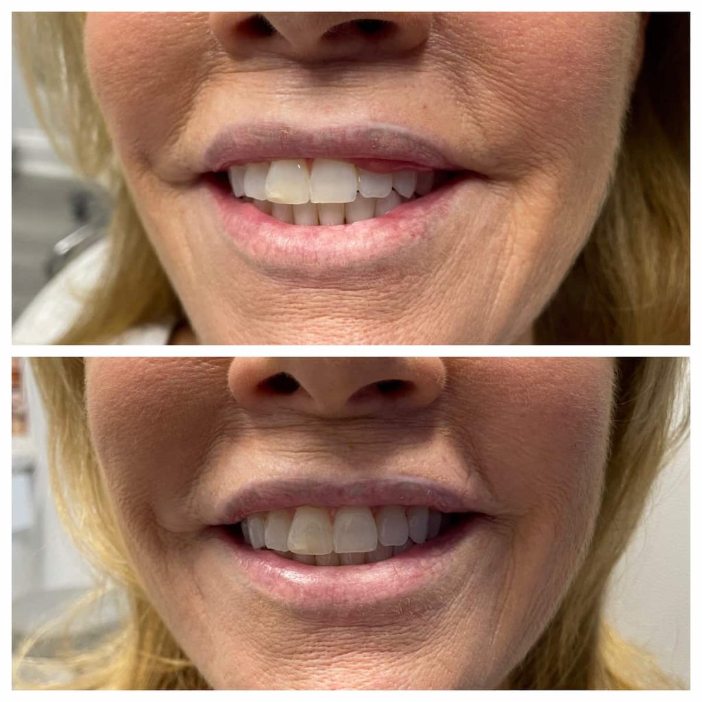 Lip Reduction Surgery St. Louis | St. Louis Dermatology & Cosmetic Surgery
