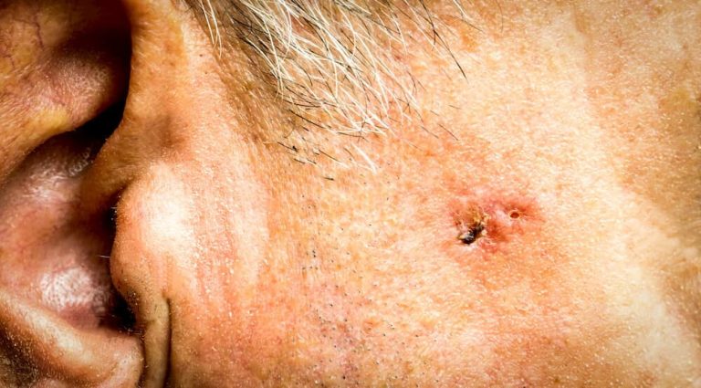 Basal Cell Carcinoma Mohs Surgery Treatment St. Louis