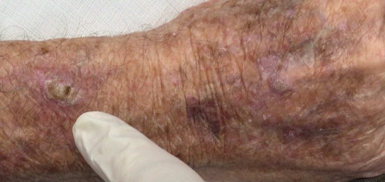 Squamous Cell Carcinoma St. Louis Dermatology & Cosmetic Surgery Mohs ...