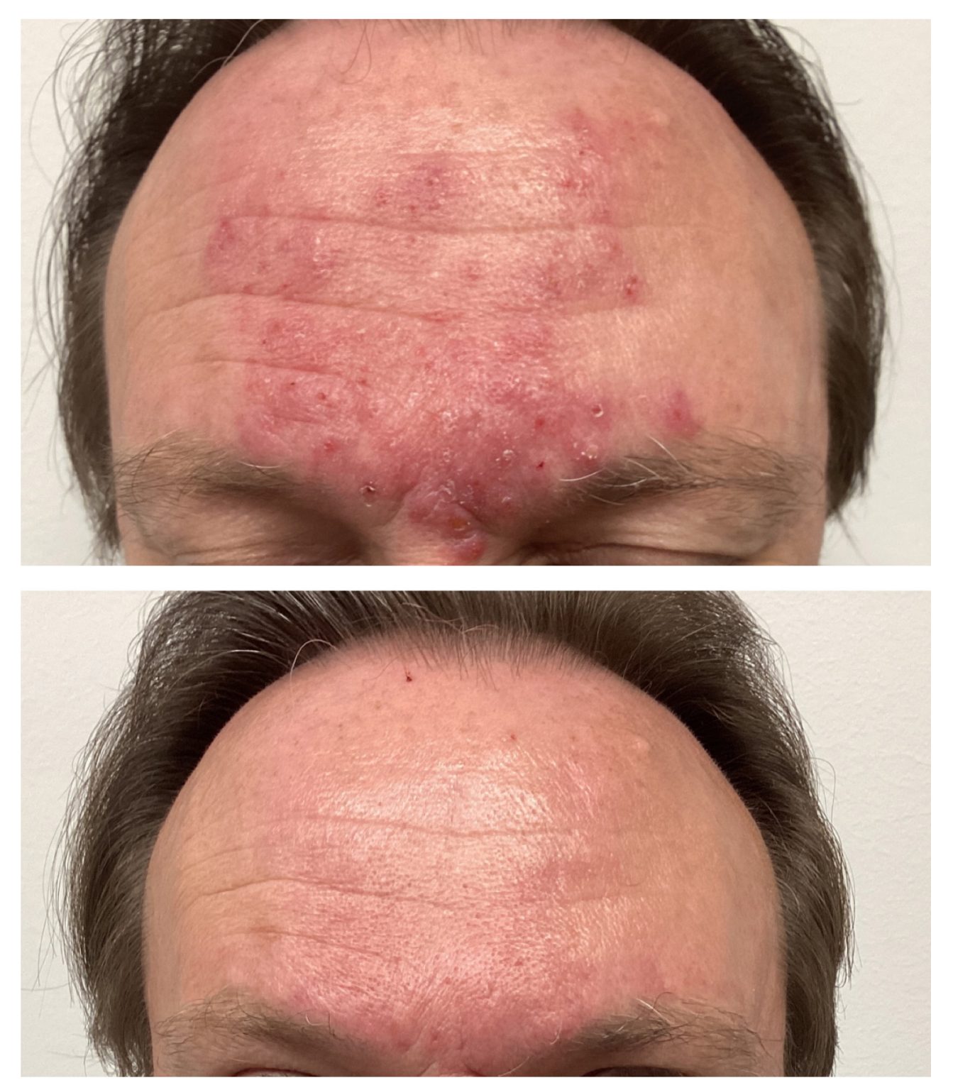 Acne Treatment St. Louis - How to get rid of Acne?