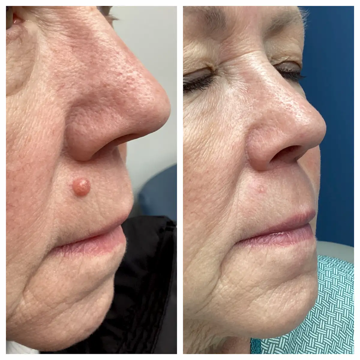 Why That ‘Pimple’ Might Actually Be a Cyst and What You Can Do About It